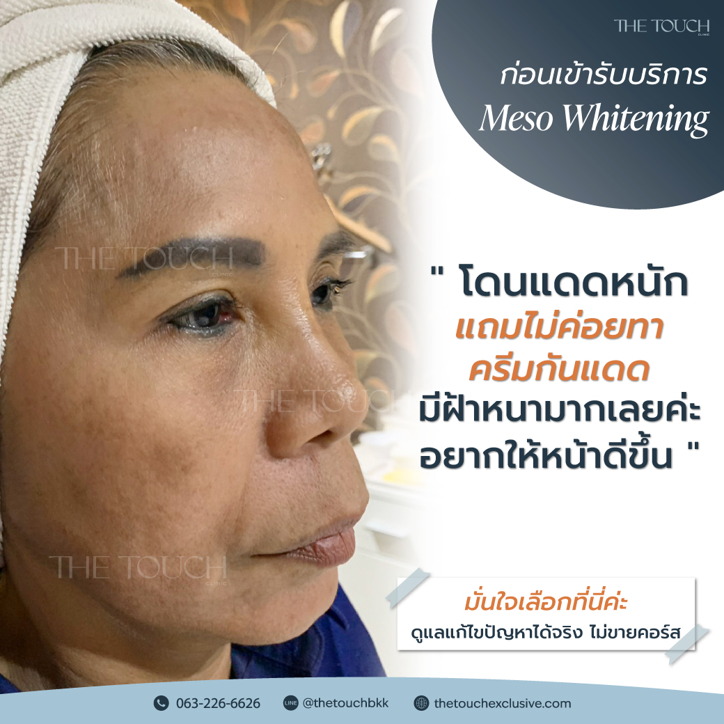 review-meso-whitening