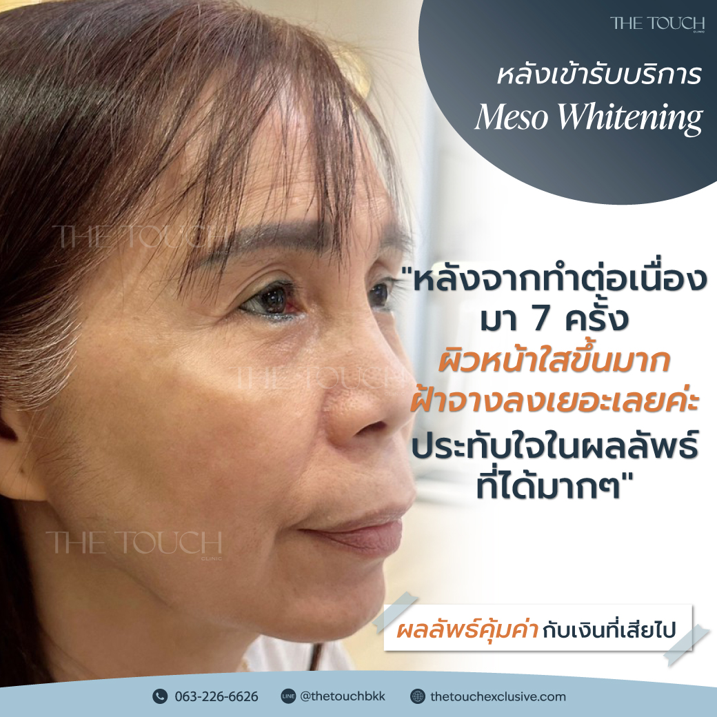 review-meso-whitening