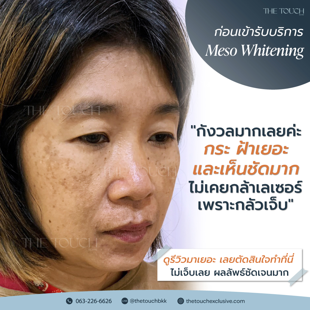 review-meso-whitening