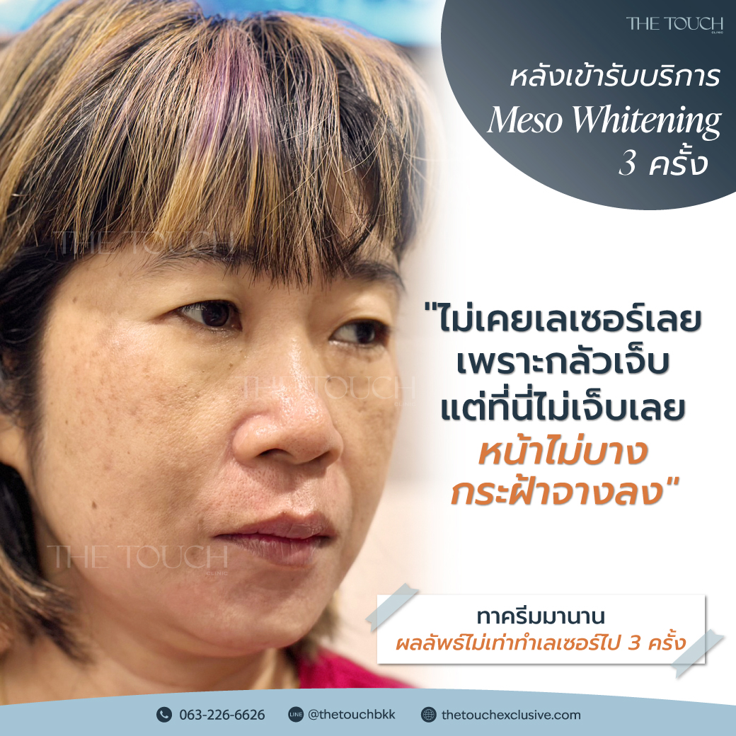 review-meso-whitening