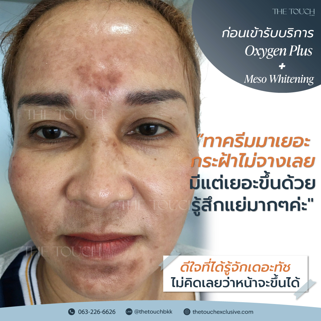 review-meso-whitening