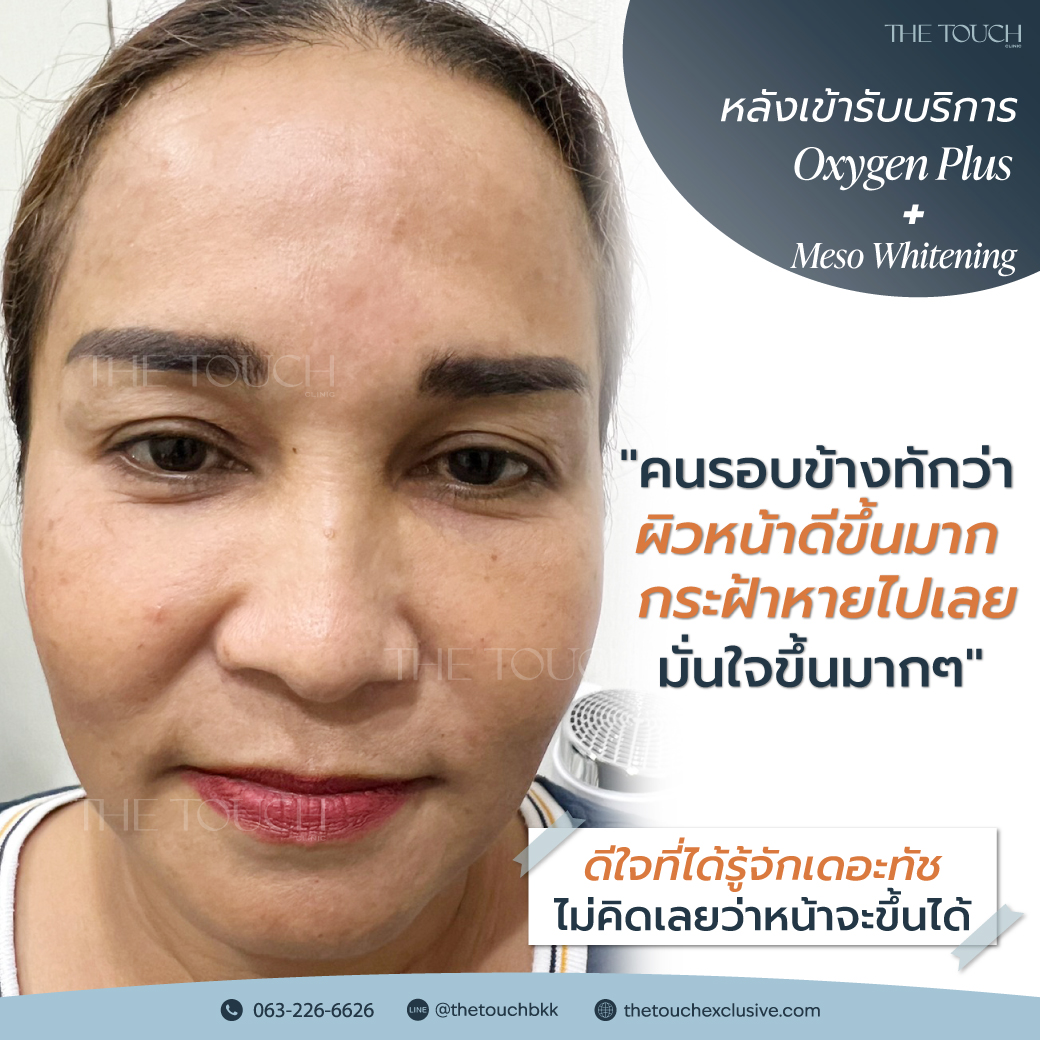 review-meso-whitening