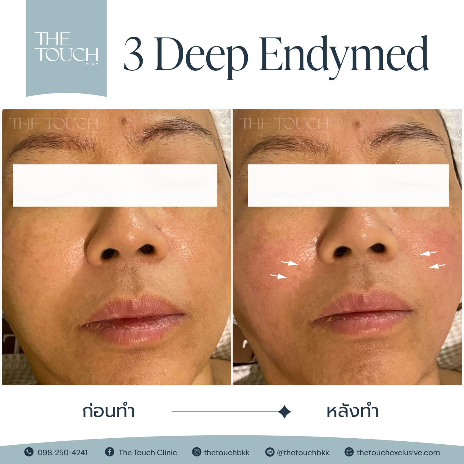 review-3-deep-endymed