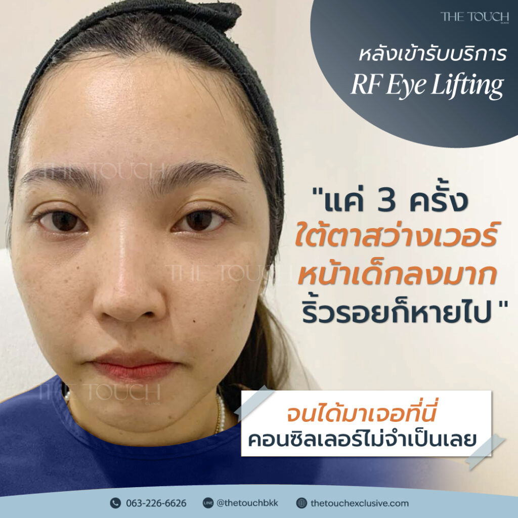 review-rf-eye-lifting