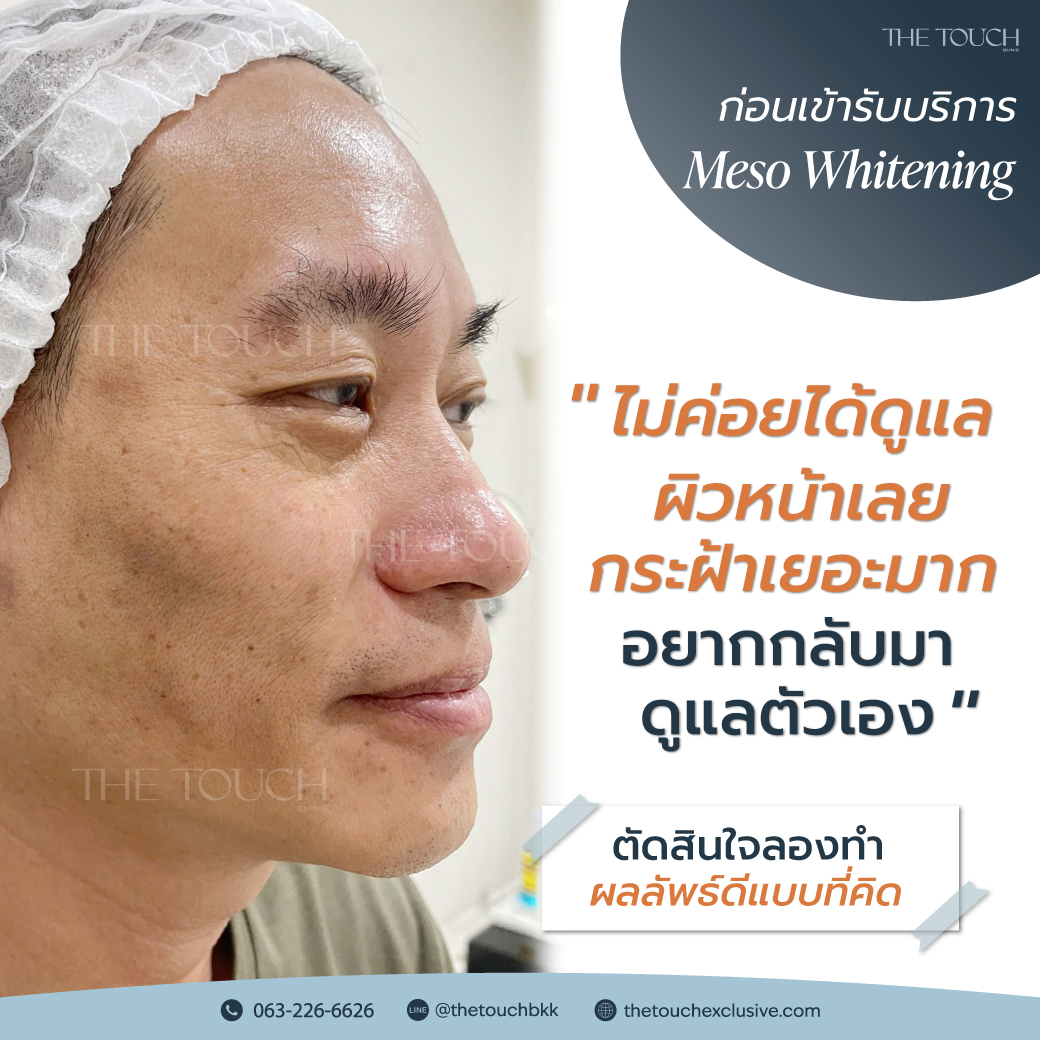 review-meso-whitening