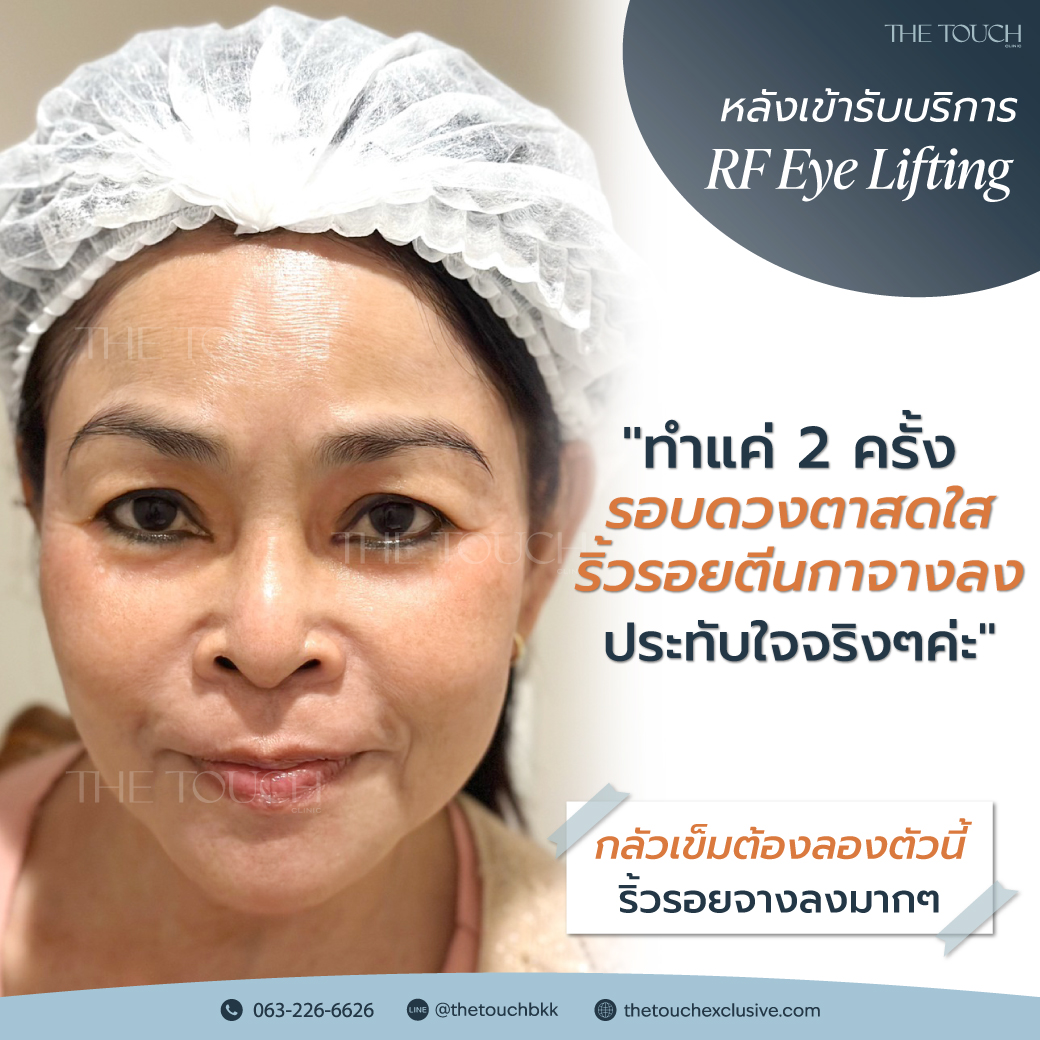 review-rf-eye-lifting