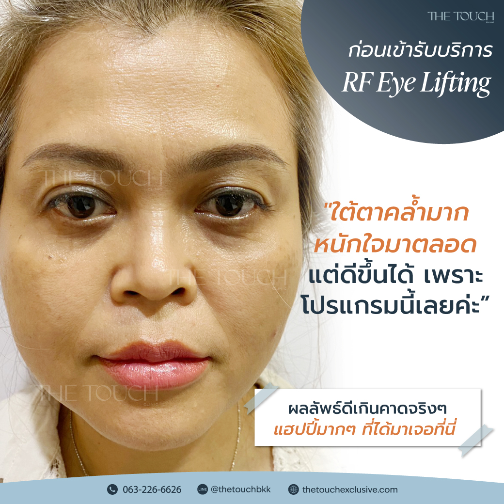 review-rf-eye-lifting