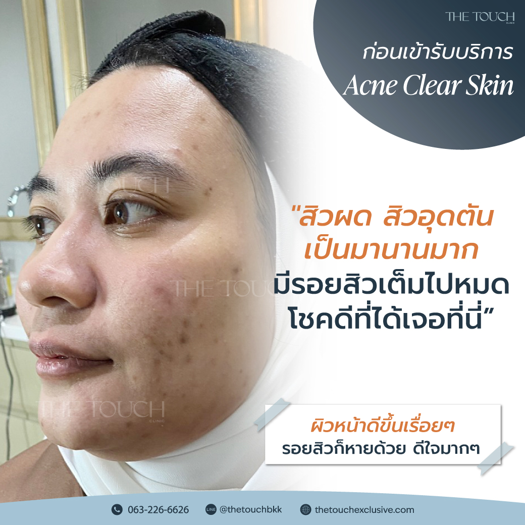 review-acne-clear-skin