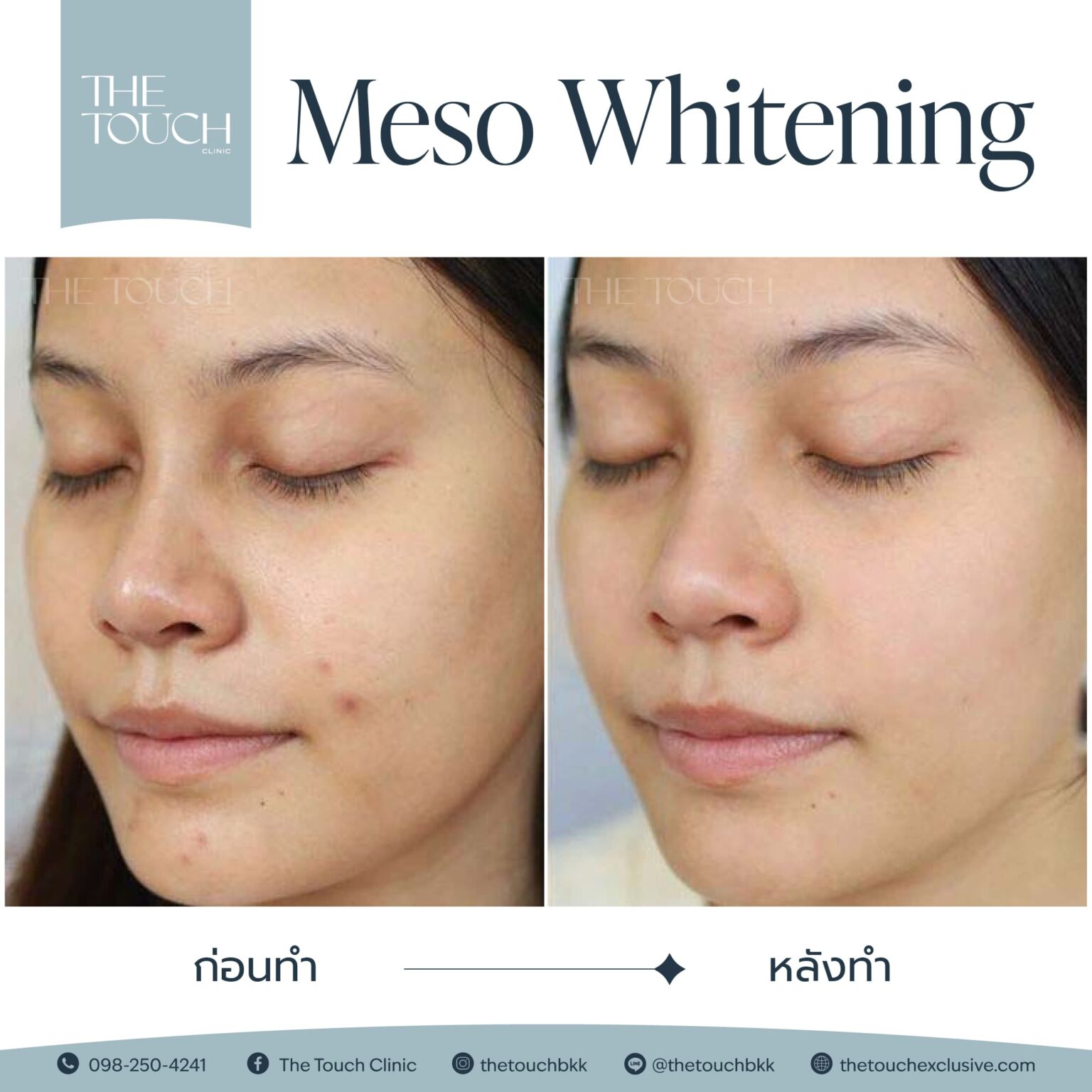 review-meso-whitening