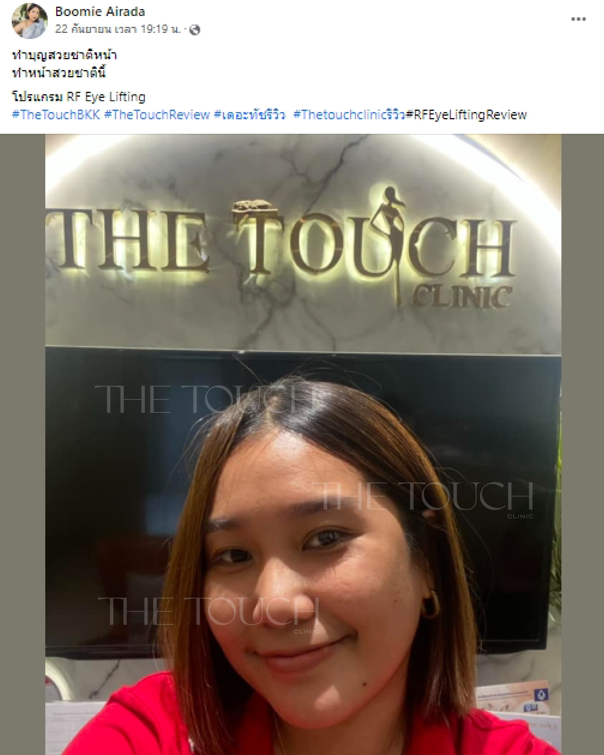 Review RF Eye Lifting – THE TOUCH EXCLUSIVE